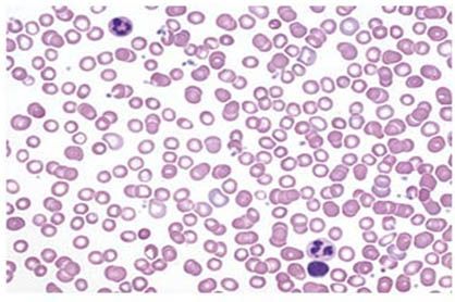 Anemia microcitica, caratteristiche e rimedi!