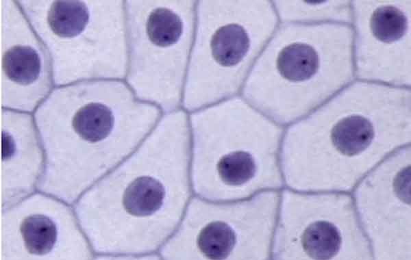 Cellule epiteliali squamose nelle urine, cosa significa?