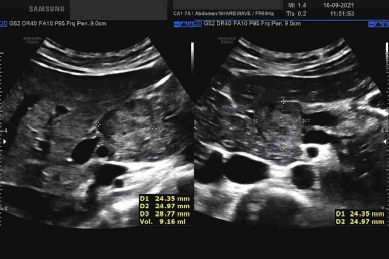 Eteroplasia: cos'è e quali forme può assumere