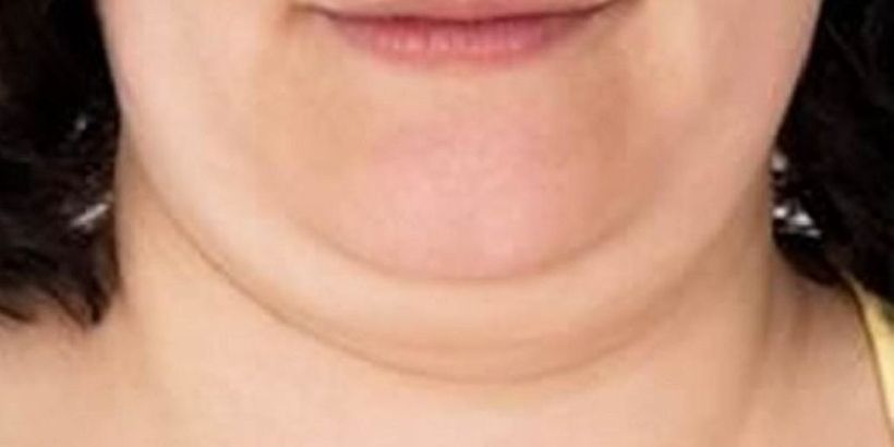 Doppio mento, il metodo veloce ed efficace per rimuoverlo