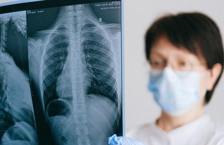 Edema polmonare: le cause dell'acqua nei polmoni e i sintomi sul corpo