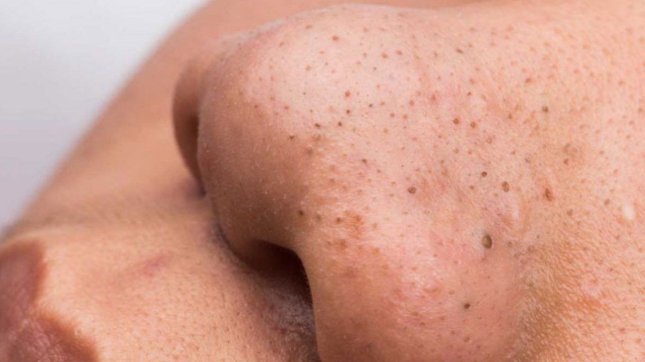 L'ingrediente miracoloso che ti permette di eliminare i punti neri - INRAN L'ingrediente miracoloso che ti permette di eliminare i punti neri - INRAN