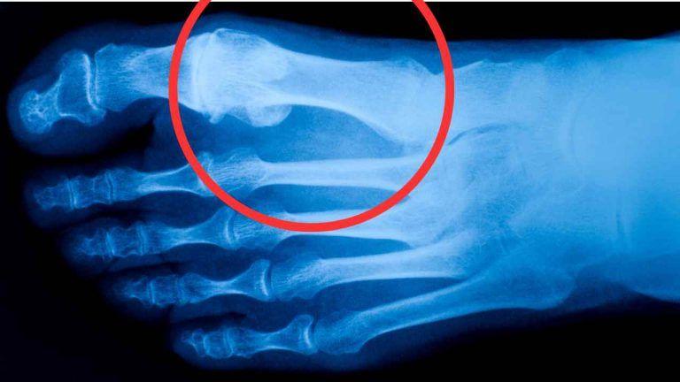 Alluce valgo, sintomi e cura e come fare sparire il dolore